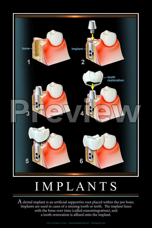 Implants #3 Wall Chart – Dental Flip Charts by Stephen F. Gordon