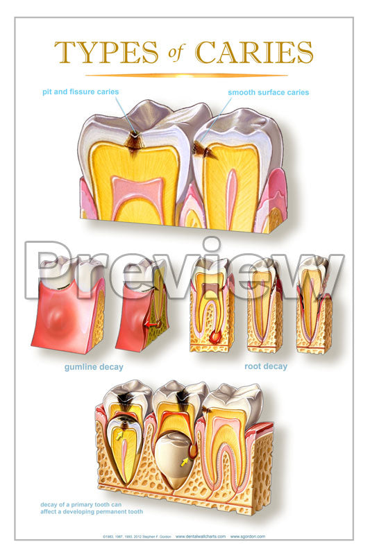 Types of Caries Wall Chart – Dental Flip Charts by Stephen F. Gordon
