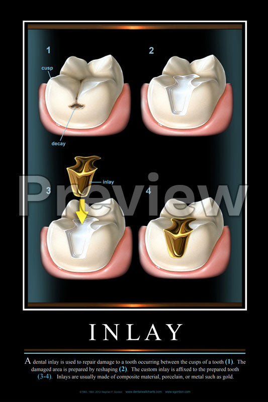 Inlay Wall Chart – Dental Flip Charts by Stephen F. Gordon