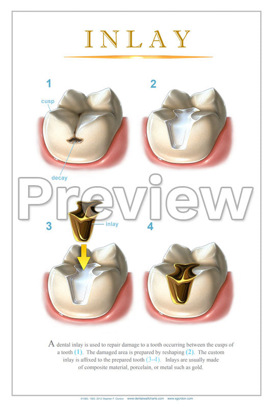 Inlay Wall Chart – Dental Flip Charts by Stephen F. Gordon